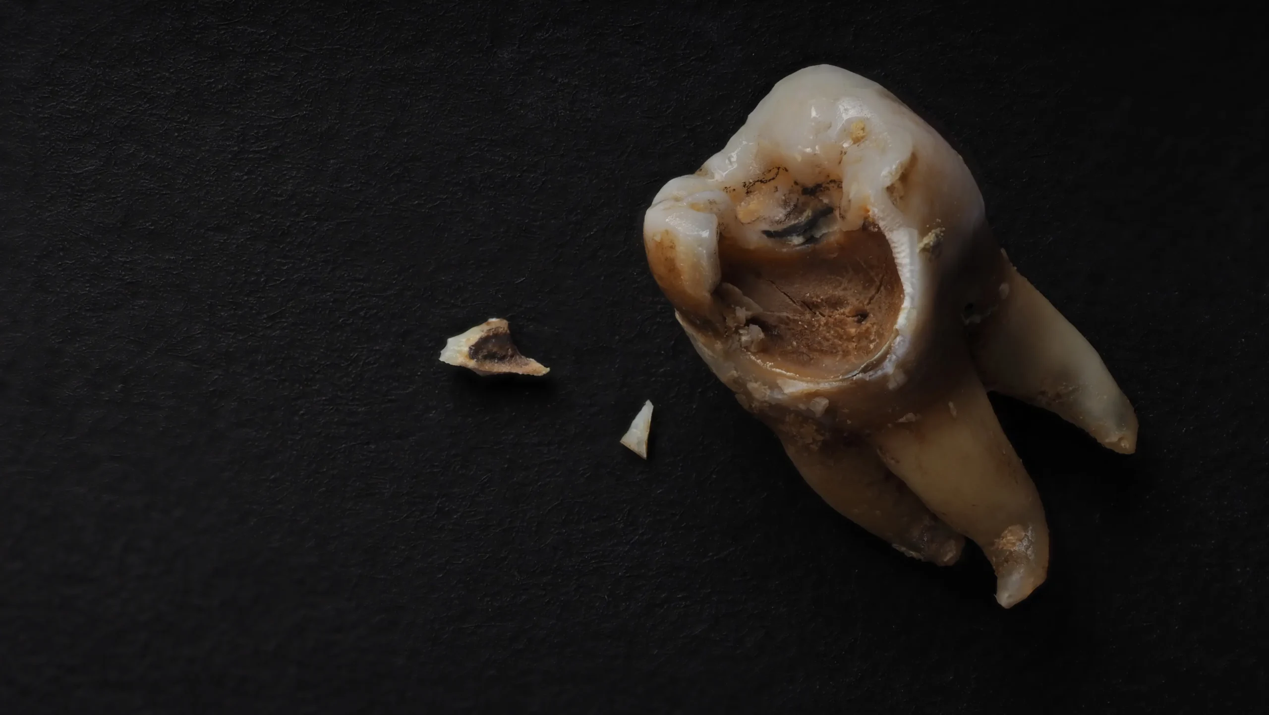Tooth Decay: Causes, Prevention, and Expert Treatment at Rajamani ...